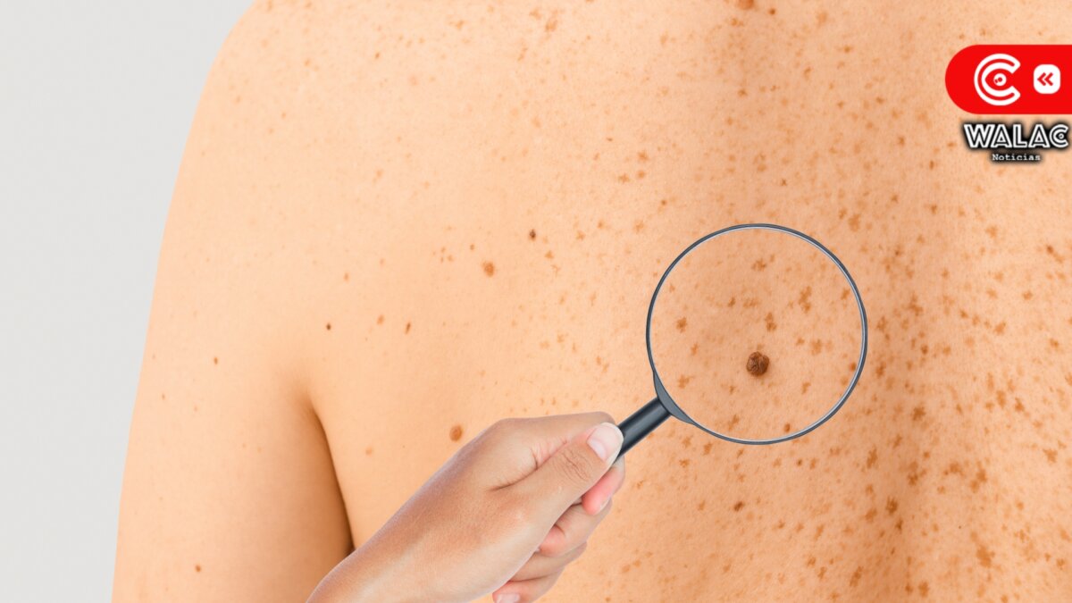Cómo identificar un lunar maligno y tomar medidas preventivas | Walac ...