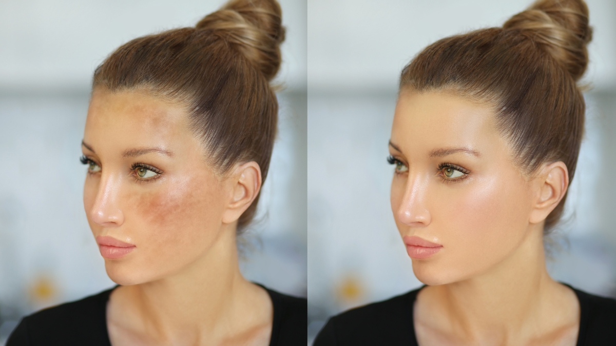 Remedios caseros para eliminar manchas oscuras en la cara | Walac Noticias